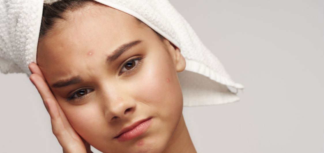 Wie Pickel loswerden? 5 natürliche Tipps, um sich von ihnen zu verabsc ...